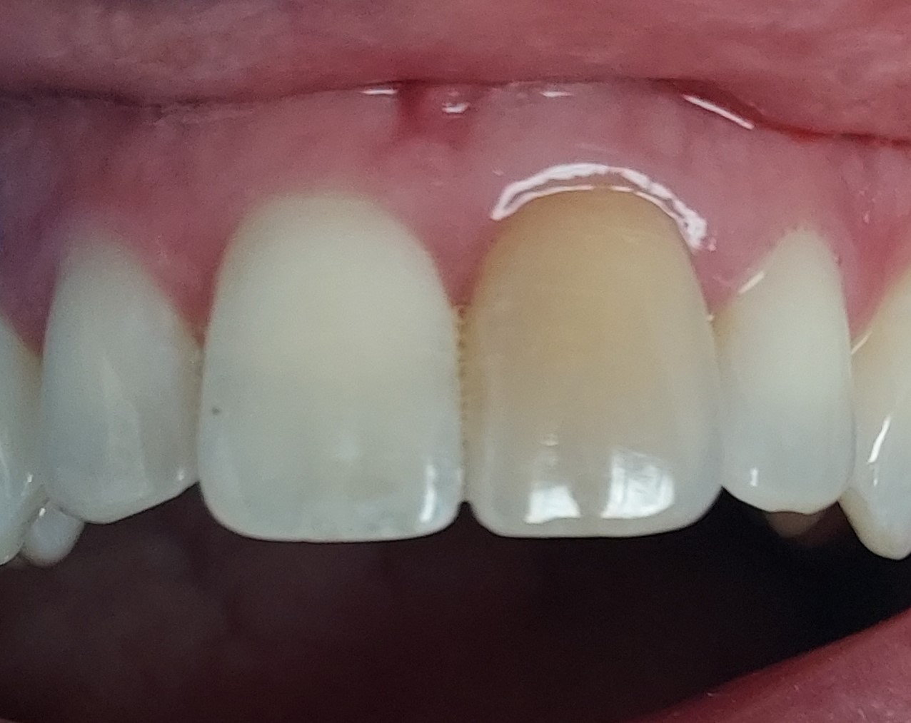 Internal Bleaching Morristown TN, Morristown Endodontics, PLLC