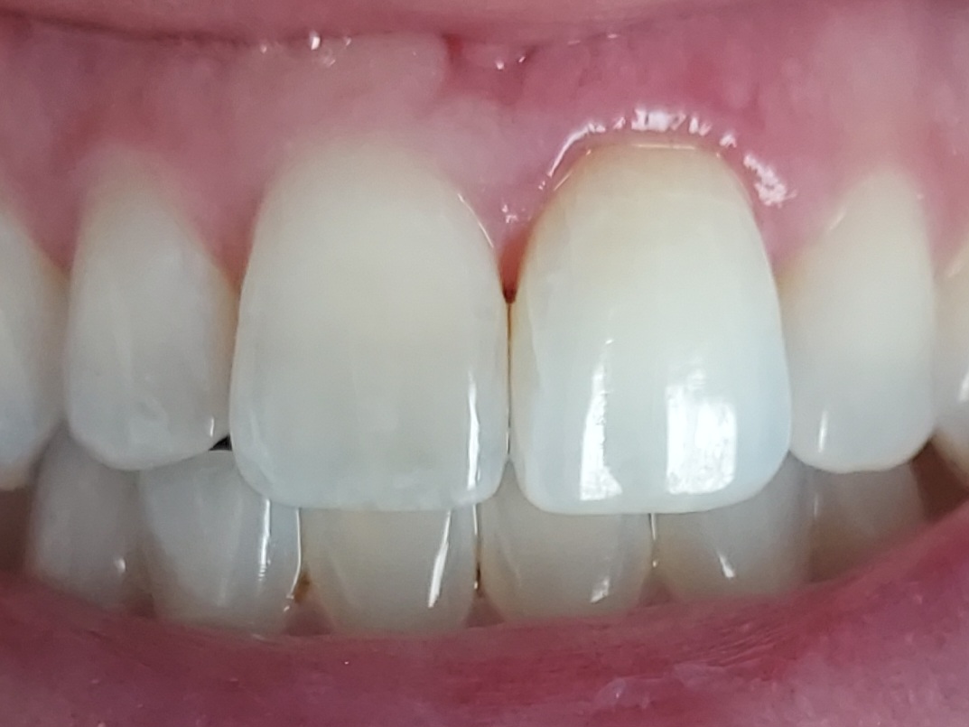 Internal Bleaching Morristown TN, Morristown Endodontics, PLLC