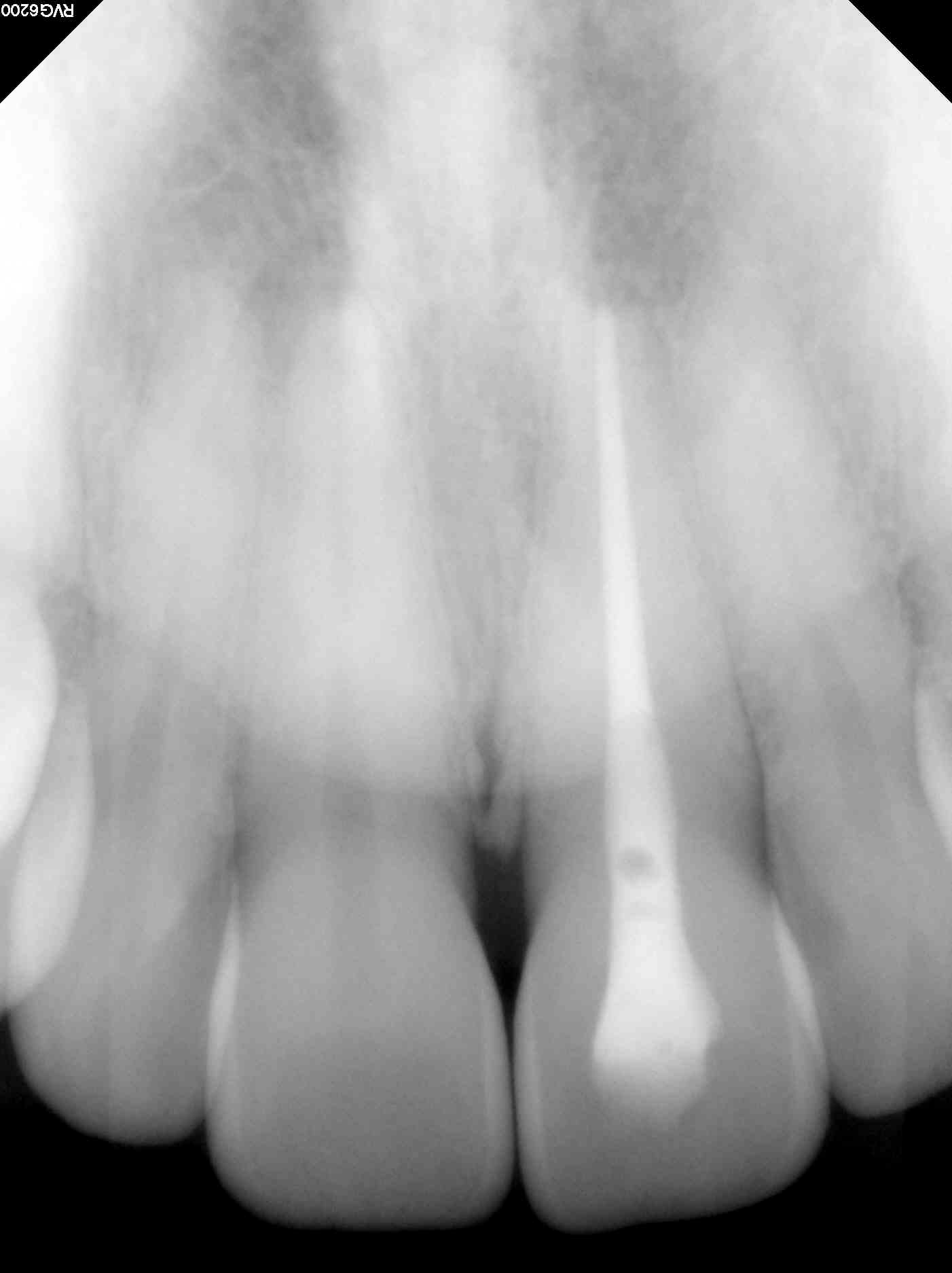 Internal Bleaching Morristown TN, Morristown Endodontics, PLLC
